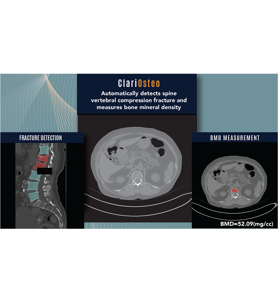 ClariOsteo | AI-Powered VCF & Osteoporosis Detection Solution with Low ...