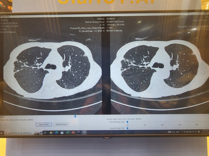 Reducing radiation exposure for cancer diagnosis - claripi